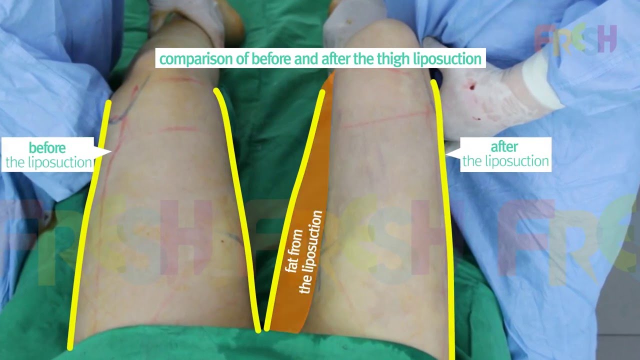Liposuction On Thighs And Knees At Dean Hammock Blog