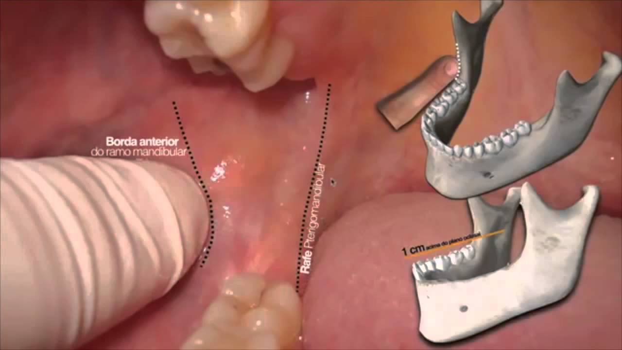 Fundamentos De Anestesia Y Exodoncia Unidad V Técnicas De Anestesia