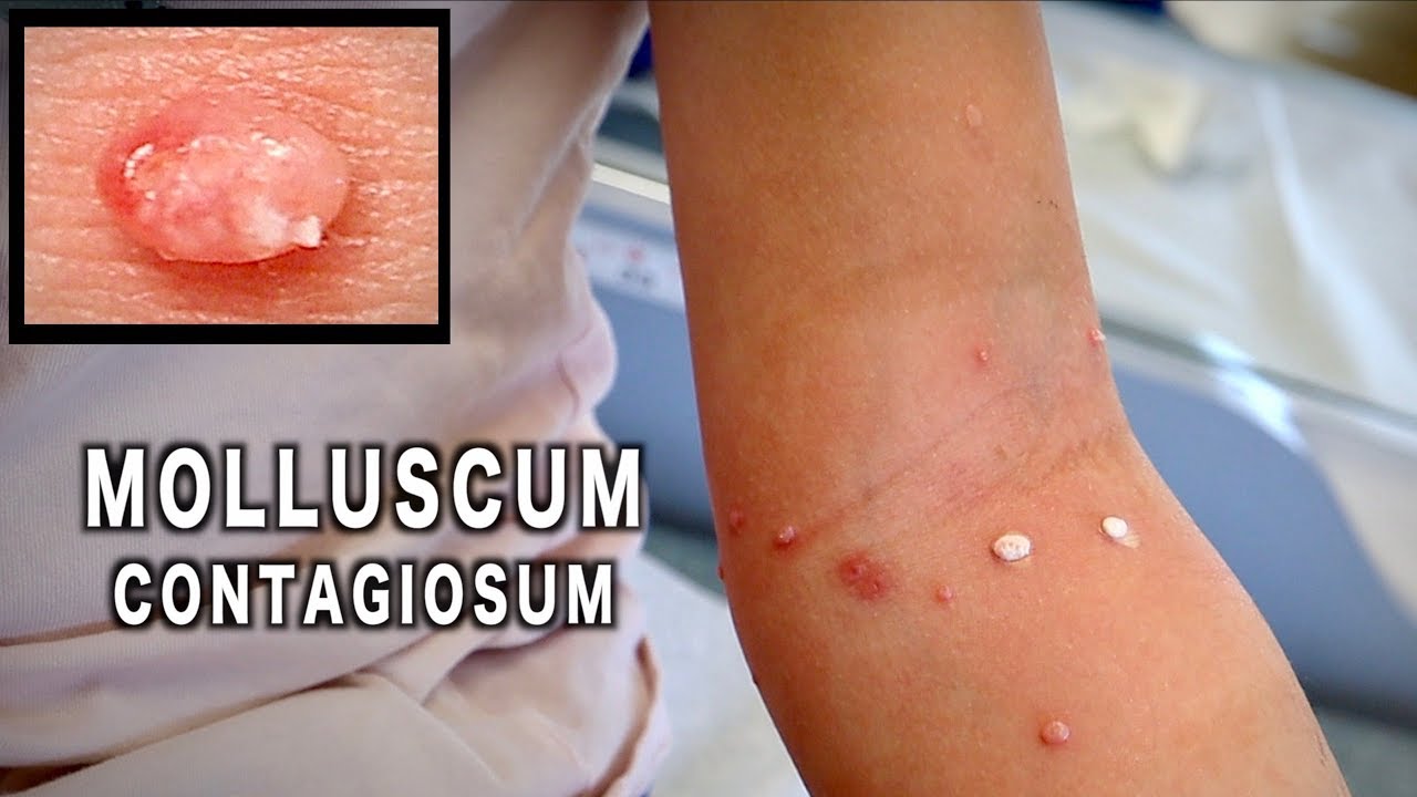 Duct Tape To Remove Molluscum Contagiosum At Madison Tietkens Blog