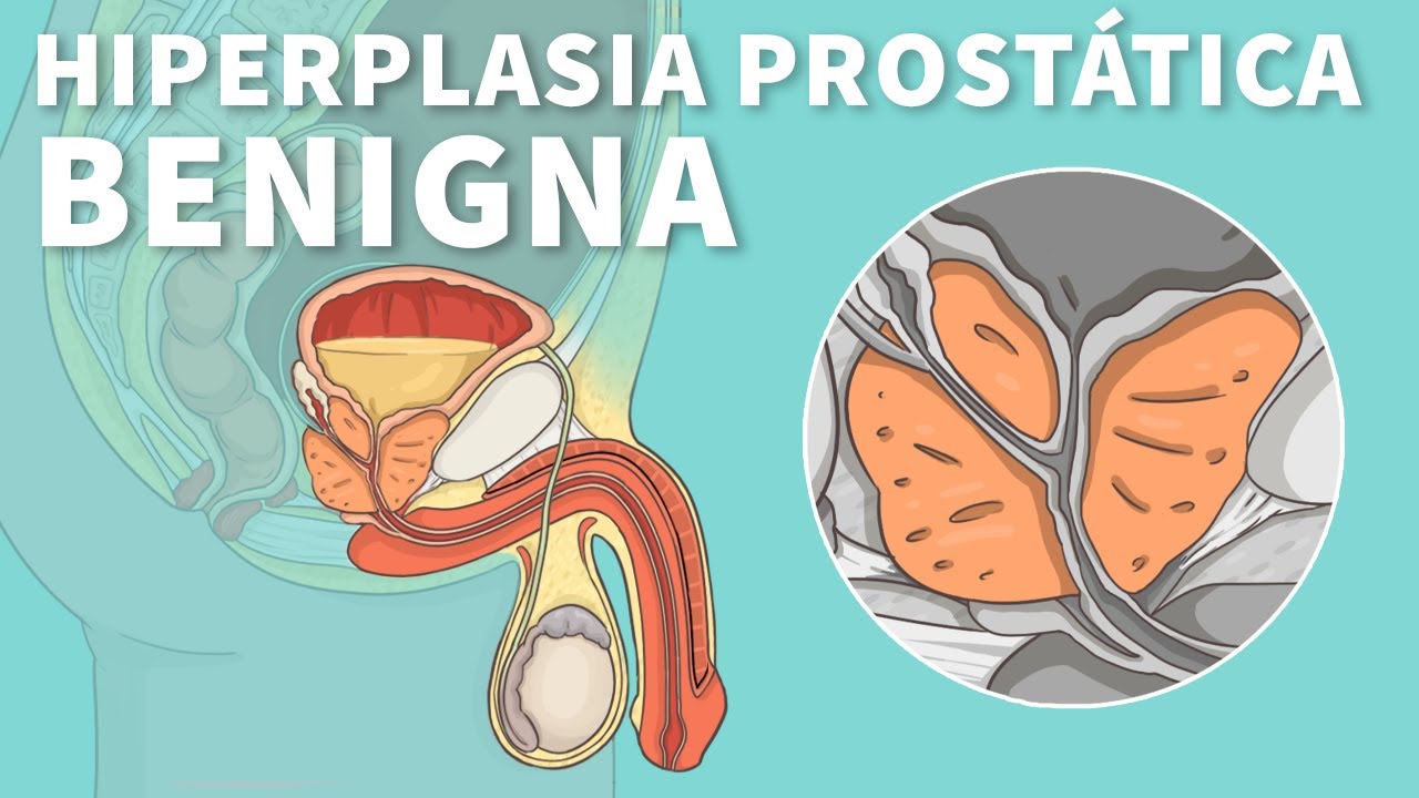 Hiperplasia Prostática Benigna Causas Síntomas Y Tratamiento Hpb