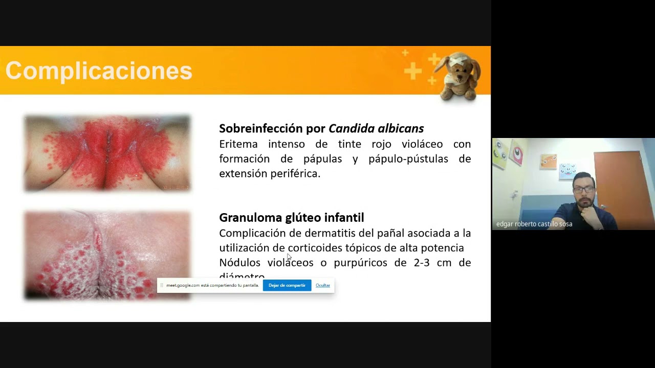 Dermatosis Mas Frecuentes En Pediatria Dr Castillo Youtube