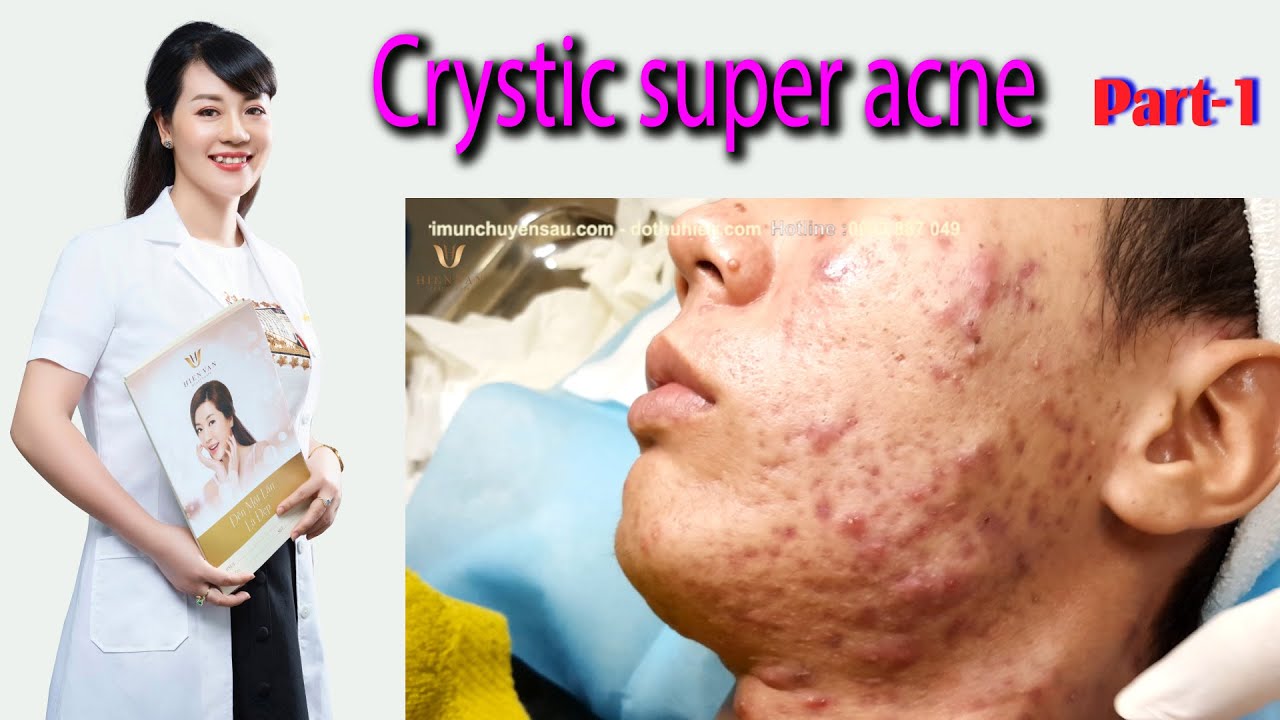 Acne Treatment Reputation Effective At Hien Van Spa 384i Lãª Tuáº N Anh