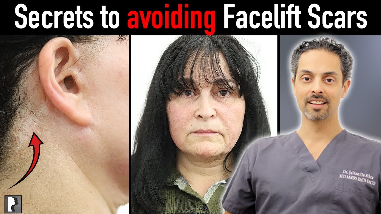 Facelift Gone Wrong Before And After New Orleans Plastic Surgery