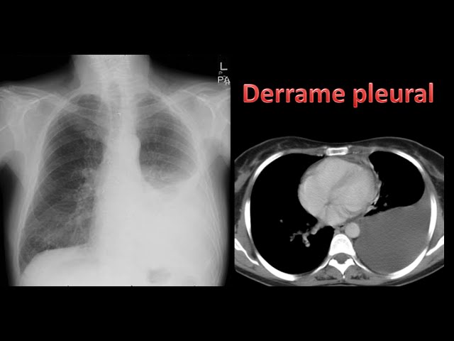Derrame Pleural Radiografia De Torax Hospital Italiano De Buenos