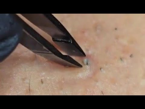8 Minutes Of Ingrown Hair Removal Bikini Area Youtube