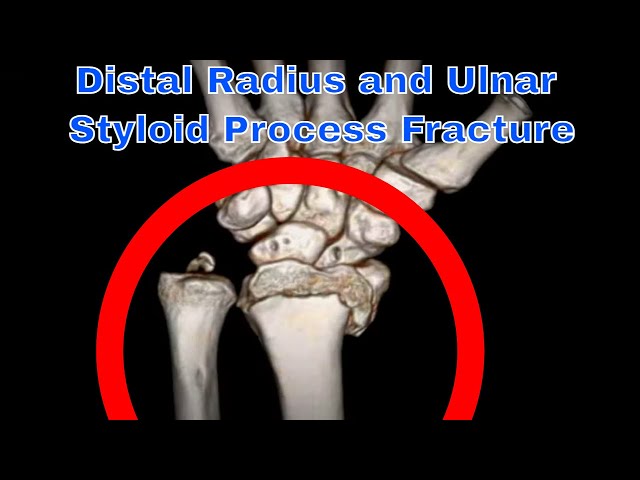 Styloid Process Of Ulna Fracture Treatment Of The Distal Forearm