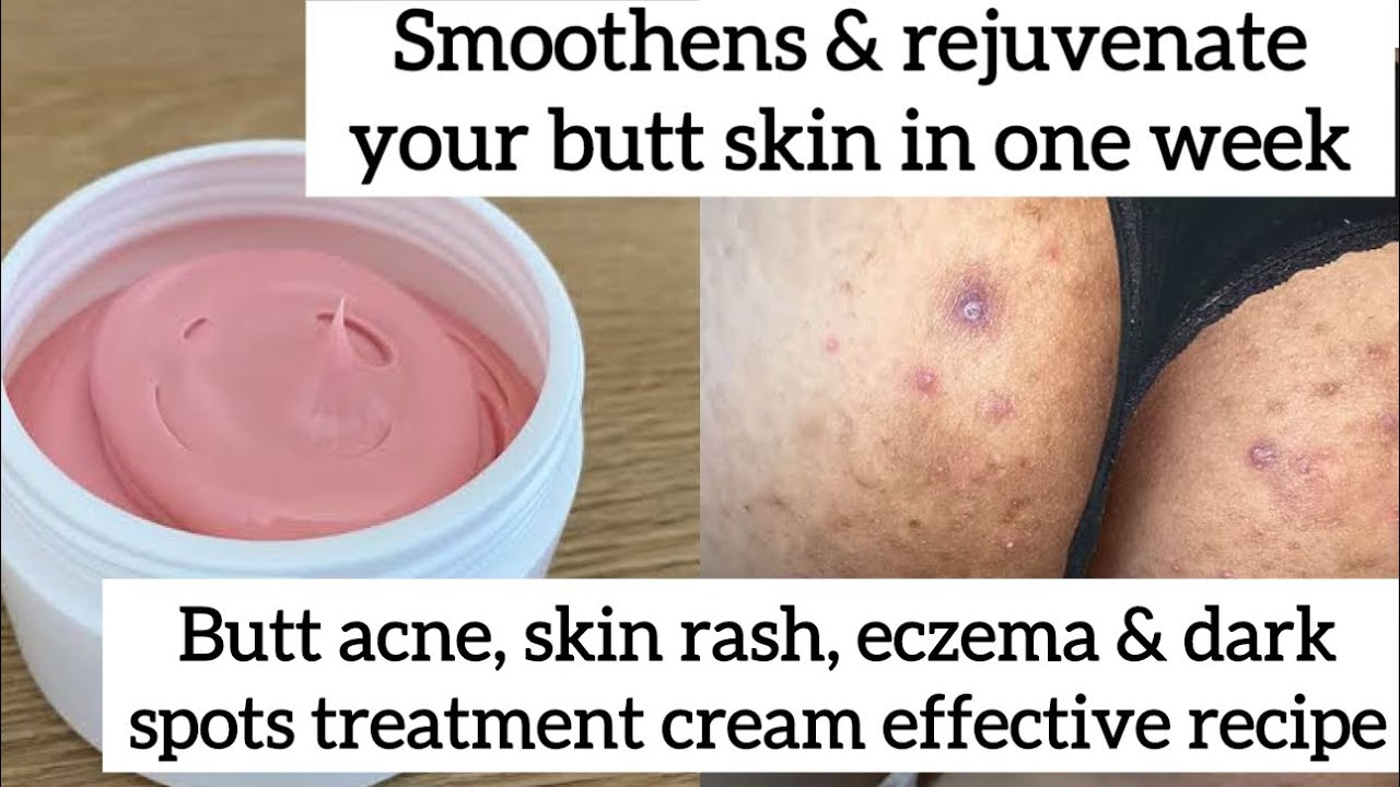 Butt Hips Acne Rash Eczema Dark Spots Treatment Cream In One Week