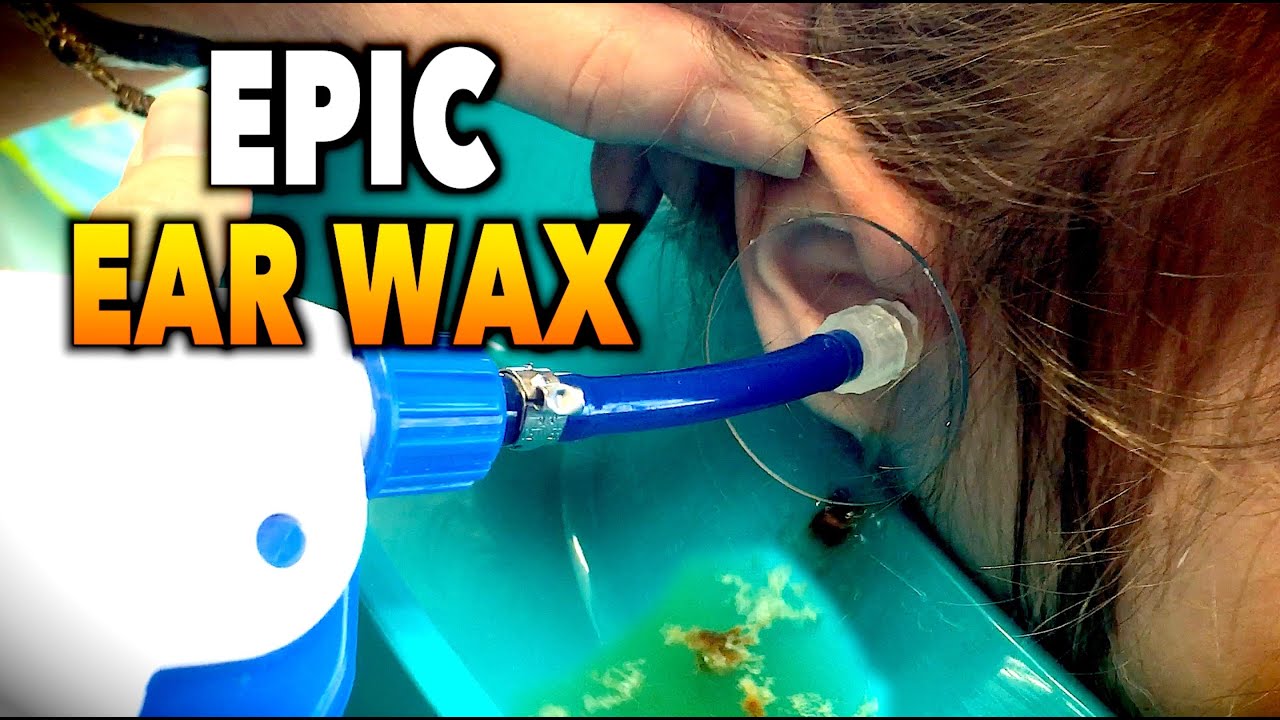 Epic Earwax Removal Dr Paul Youtube