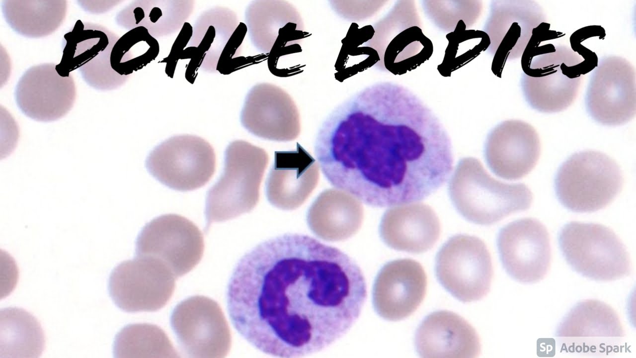 Döhle Bodies Present On Peripheral Blood Smear Hematopathology