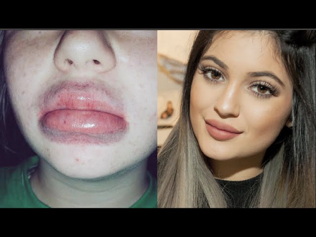 Bruised Lips From Kylie Jenner Challenge Lipstutorial Org