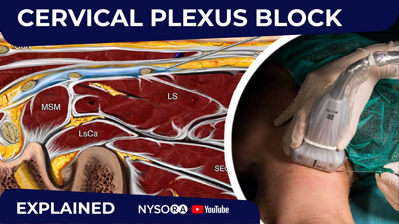 Cervical Plexus Block Regional Anesthesia Crash Course With Dr