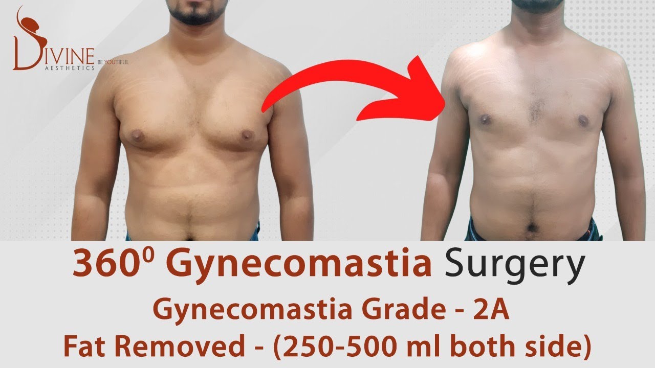 How To Shape Chest After Gynecomastia Surgery At Sophia Dadswell Blog