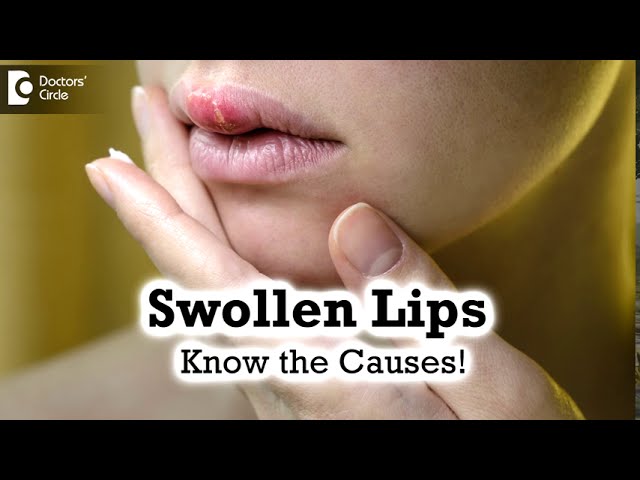 What Allergy Causes Swollen Lips Infoupdate Org