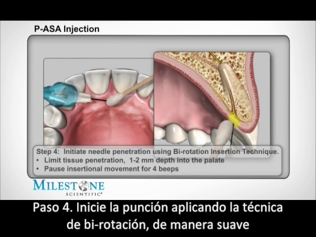 Nervio Alveolar Superior Posterior Región Del Tercer Molar Inferior