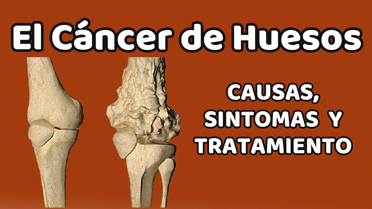Cáncer De Huesos Causas Signos Y Síntomas Diagnóstico Y Tratamiento
