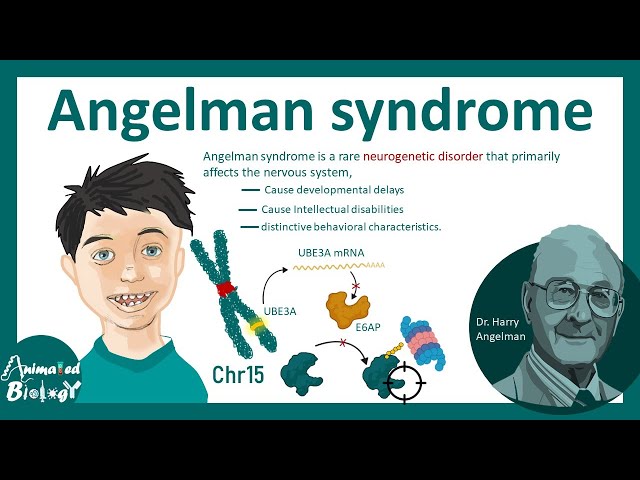 Angelman Syndrome Causes Symptoms And Treatment