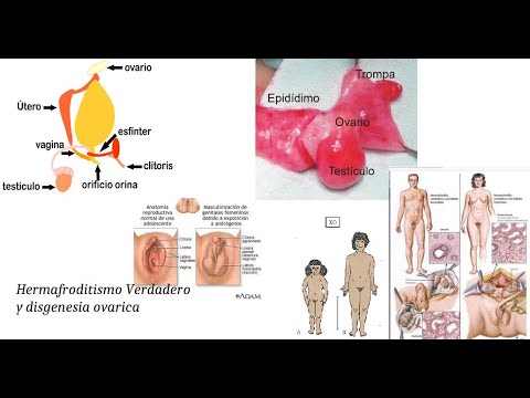 Hermafroditismo Verdadero Y Disgenesia Ovarica Youtube