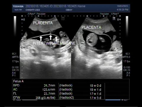 Triplet Pregnancy Of About 18 Weeks On Ultrasound Youtube