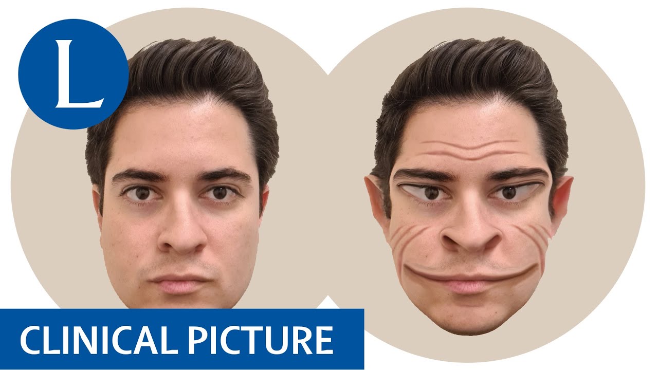 Visualising Facial Distortions In Prosopometamorphopsia Youtube
