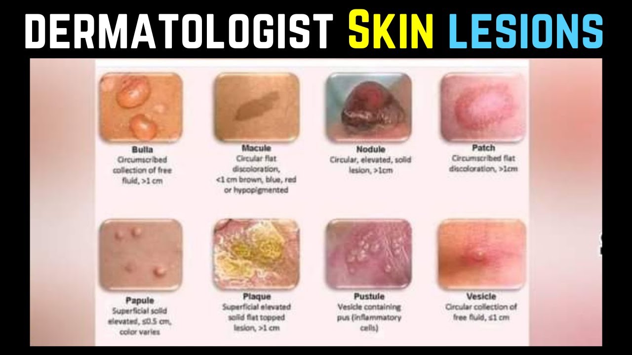 Dermatology Terminology Of Skin Lesions