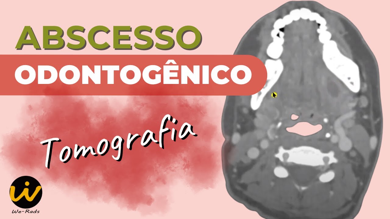 Abscesso Odontogênico Tomografia Youtube