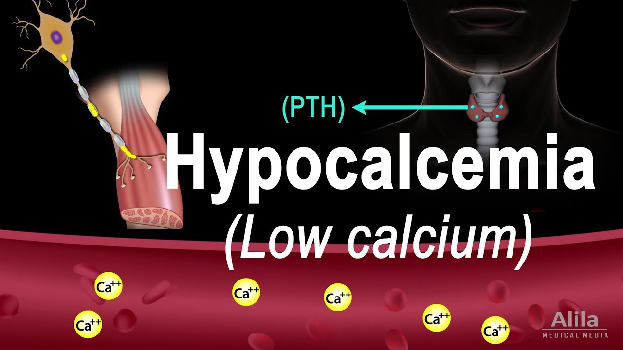 Hypocalcemia Low Calcium Pathology Causes Symptoms And Treatment