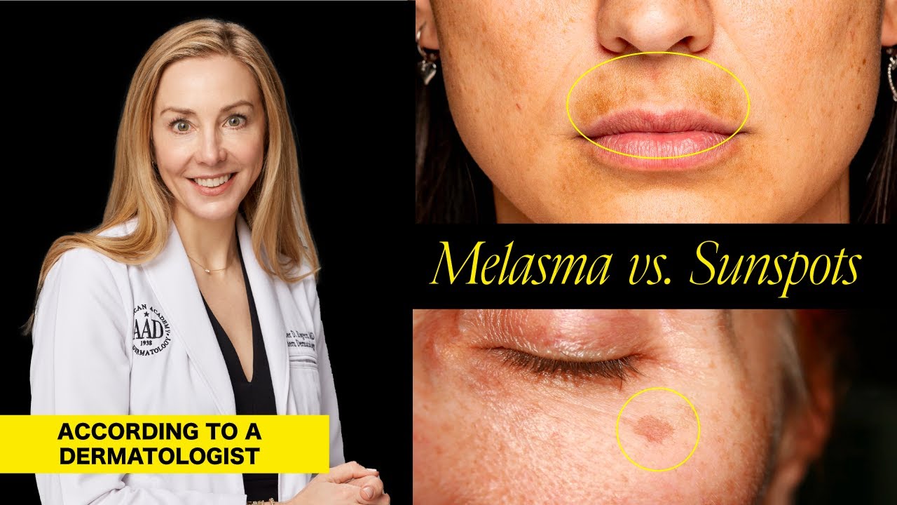 Understanding Melasma And Sunspots Key Differences Causes And Treatment ...