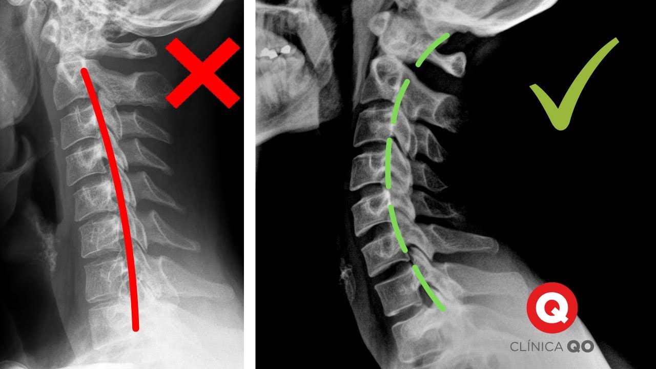 Rectificación Cervical Qué Es Ejercicios Y Consejos Youtube