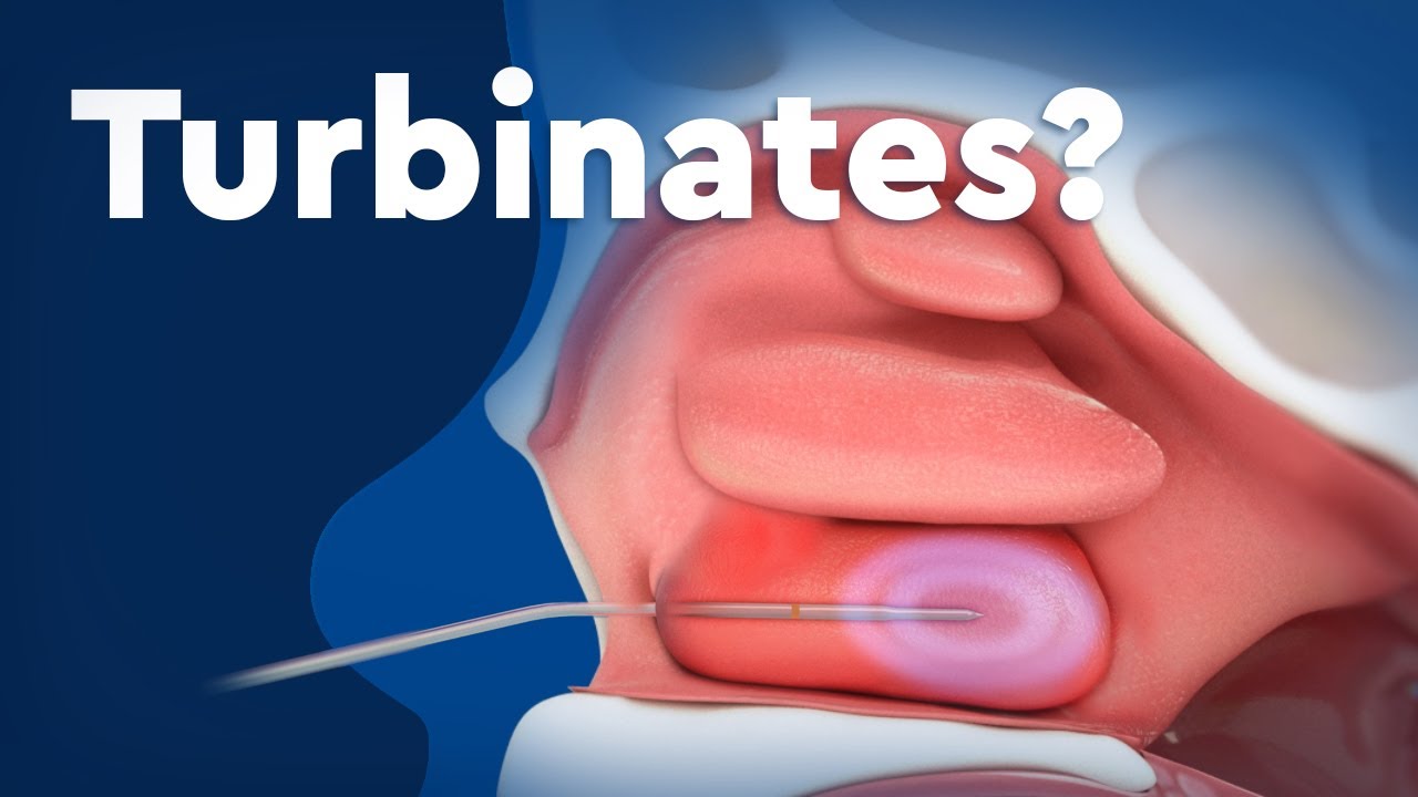 Nasal Turbinate Reduction In Children Youtube