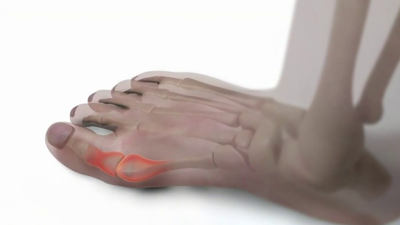 Battling Bunions What Causes Them How They Can Be Managed Youtube