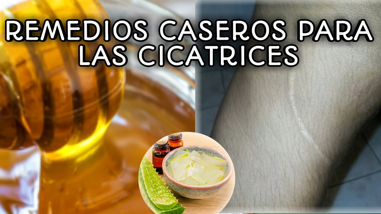 Remedios Caseros Para Curar Las Cicatrices Borrar Las Cicatrices De