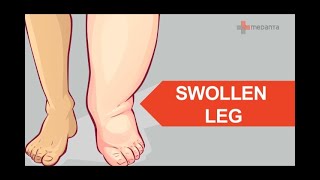 Swollen legs - causes, symptoms, and treatment