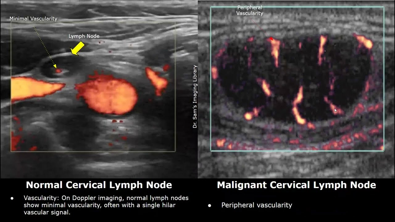 Benign Or Malignant Lymph Nodes Ultrasound Introduction Of The Who