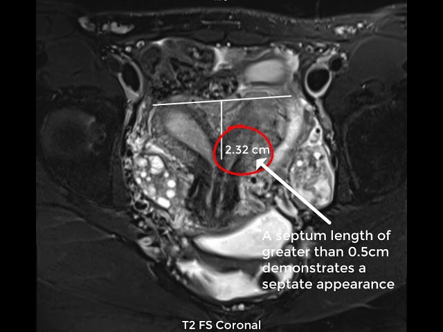 Uterine Septum Mri The Radiology Assistant Müllerian Duct Anomalies