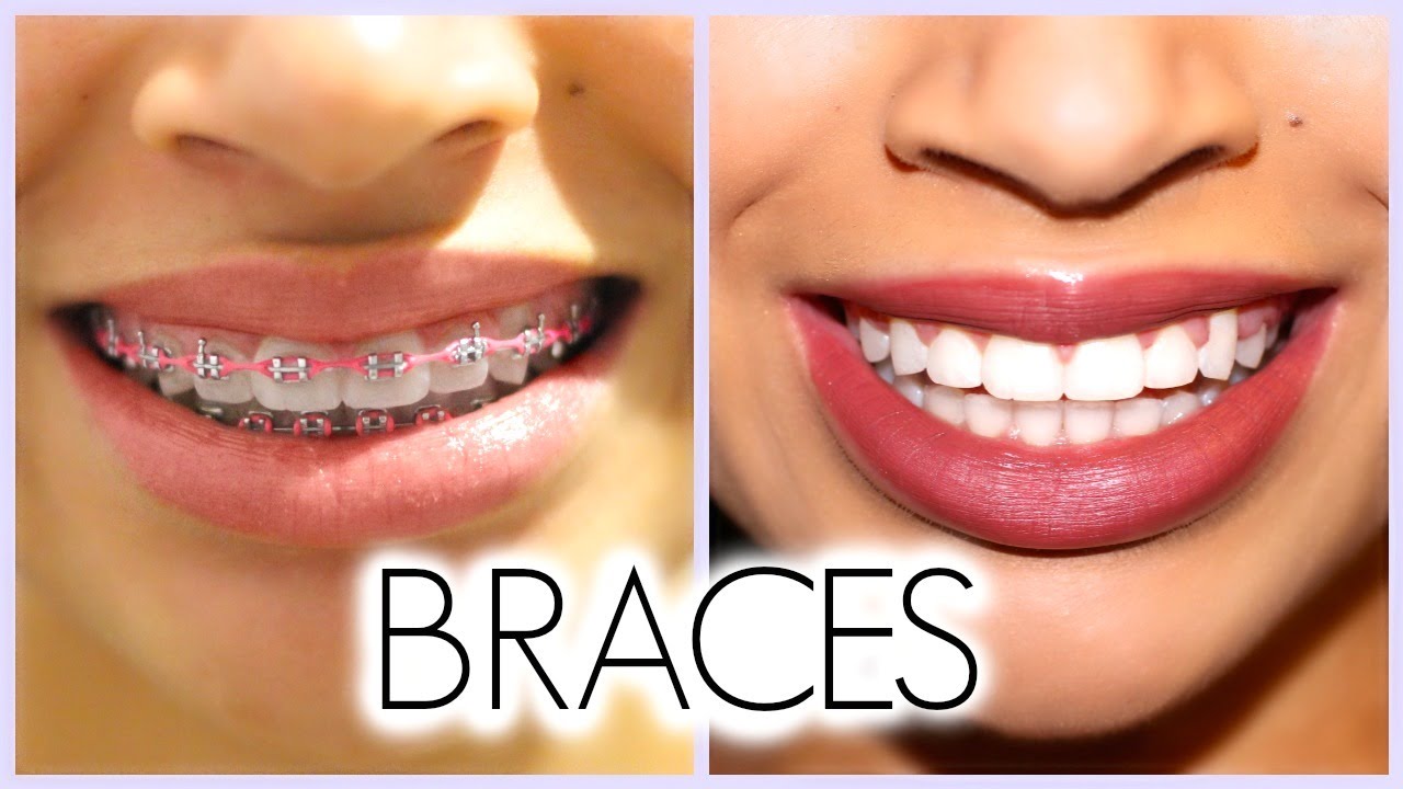 Gapped Teeth Before And After Braces Floridahac
