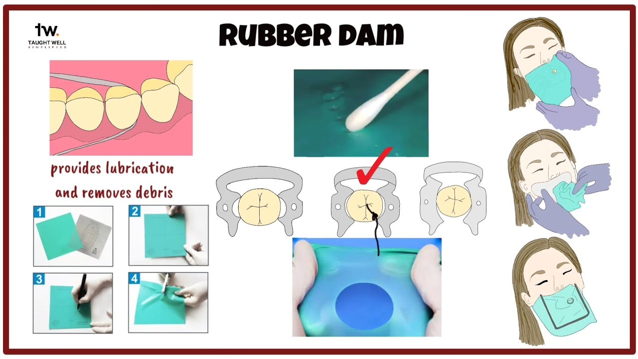 Rubber Dam Purpose At Ann Shafer Blog