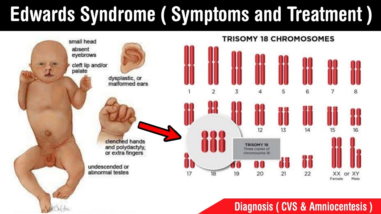 Edwards Syndrome Trisomy 18 Causes Symptoms And Types