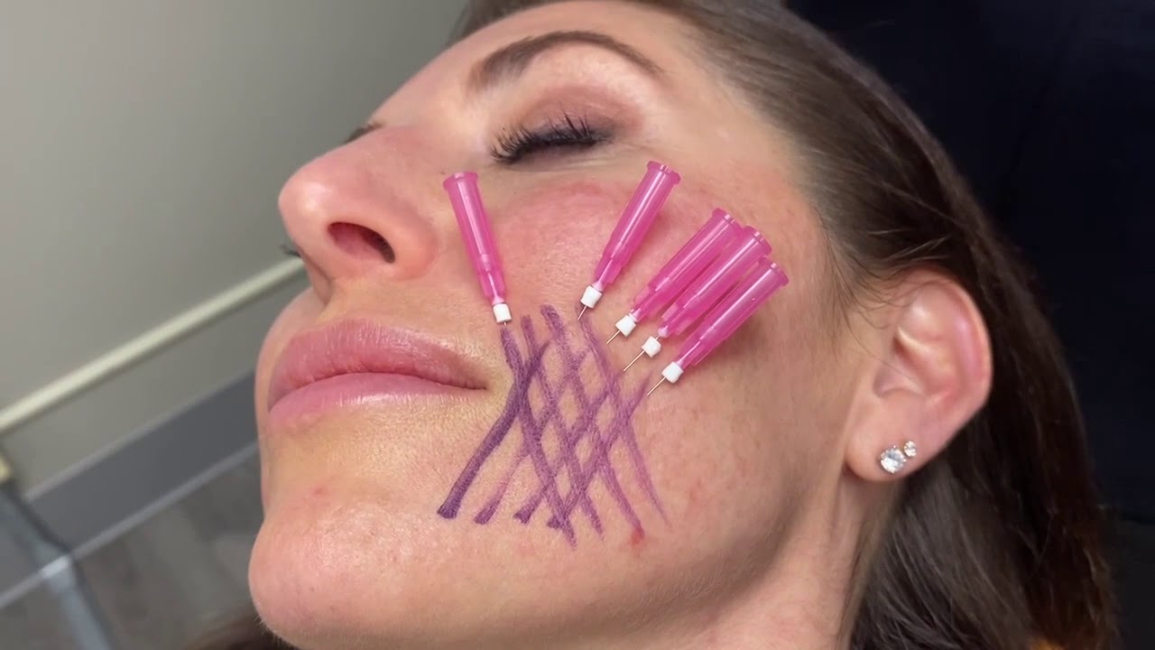 Full Face Treatment With Vsoft Lift Pdo Threads Youtube