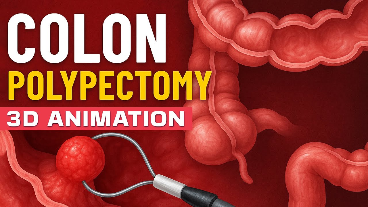 Colon Polypectomy How Polyps Are Removed From Large Intestine 3d