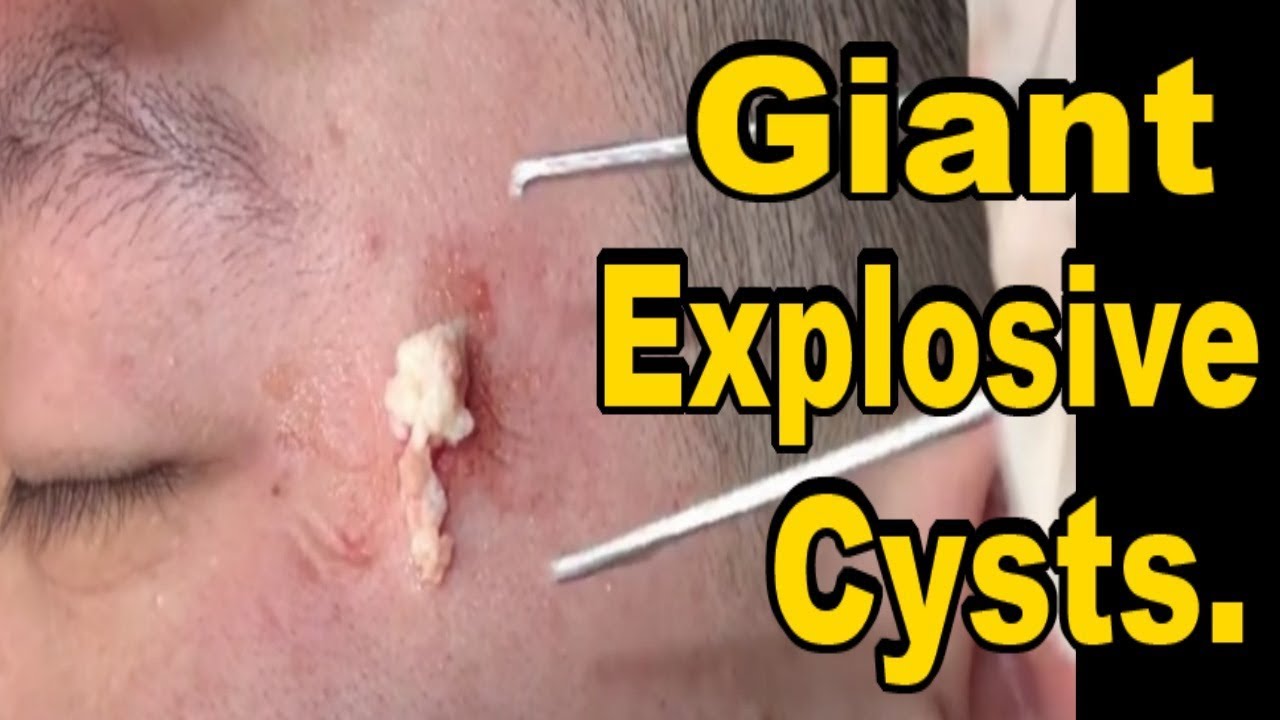 Big Explosive Flying Cyst Big Cyst Removal From Face 源thank You For
