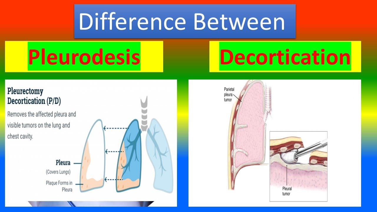 Difference Between Pleurodesis And Decortication Youtube