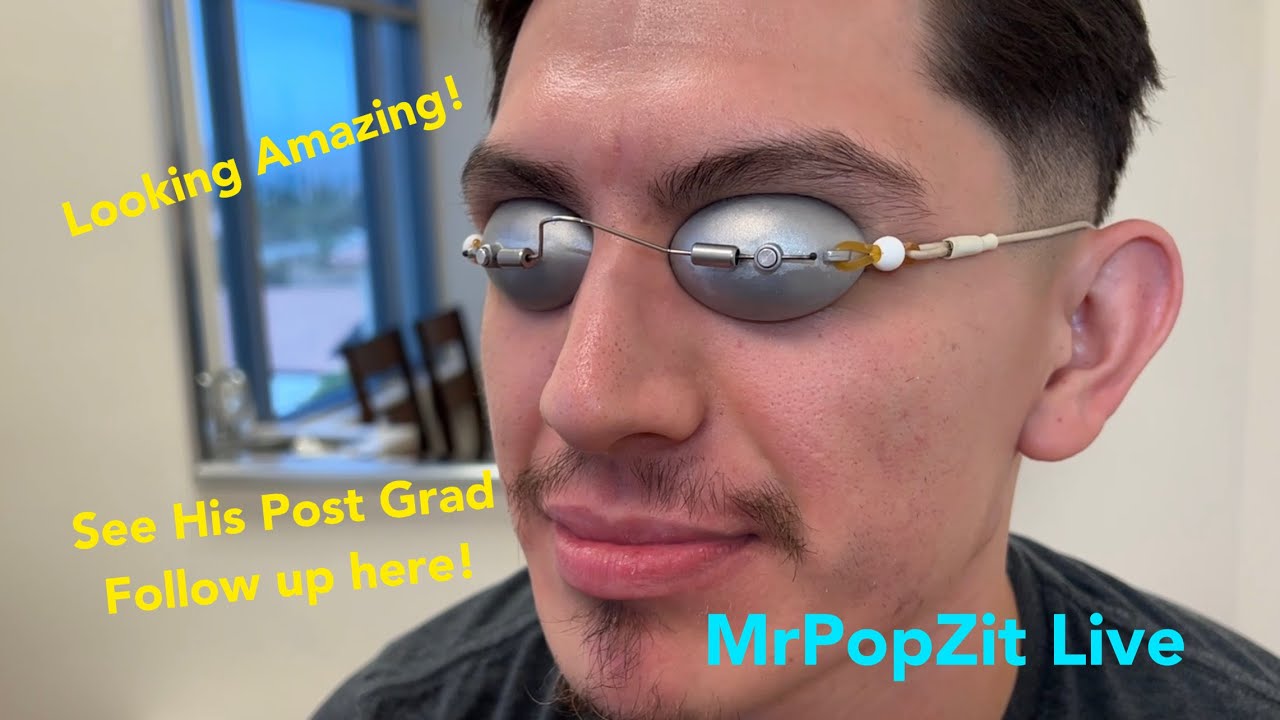 Come Over To Mrpopzit Live Now My Severe Acne Patient Follow Up After
