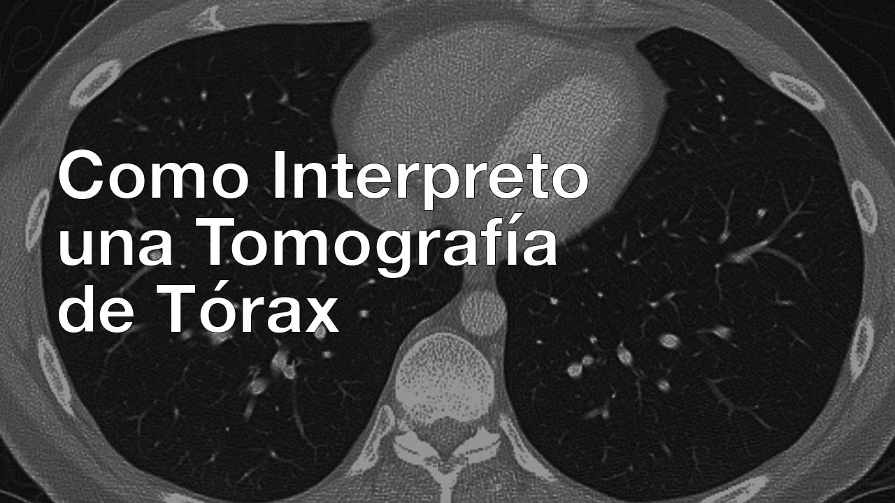 Anatomía De La Tomografía Computarizada Del Tórax Toracostomía Con