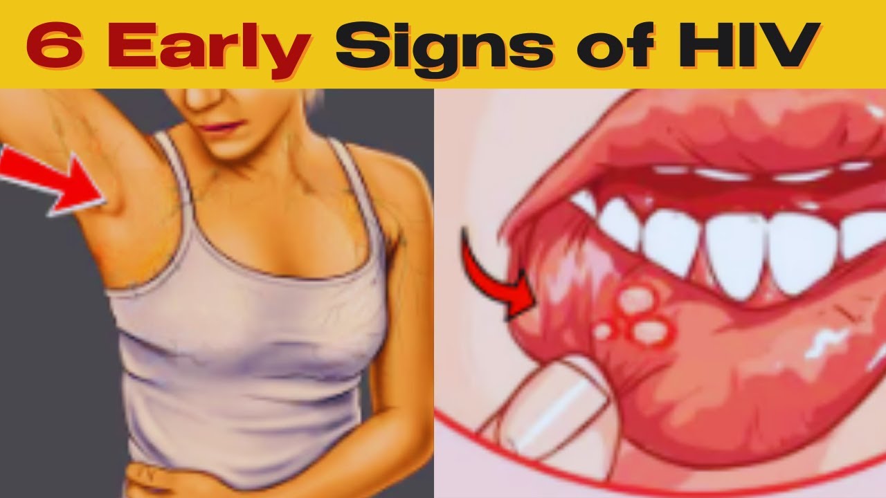 6 Early Hiv Symptoms In Men Women Critical Hiv Warning Signs 2025