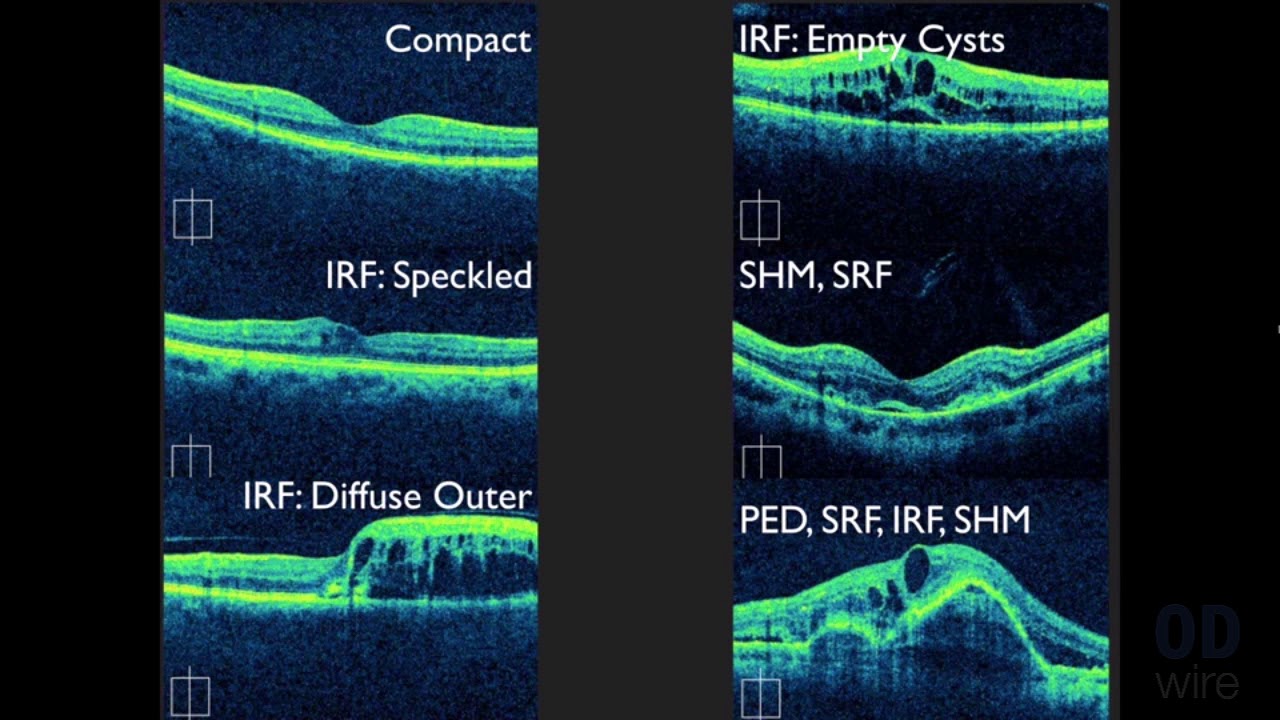 Macular Oct Interpretation A Practical Discussion With Dr David E