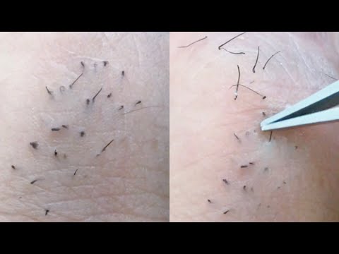 Ingrown Hair Removal Satisfying Youtube