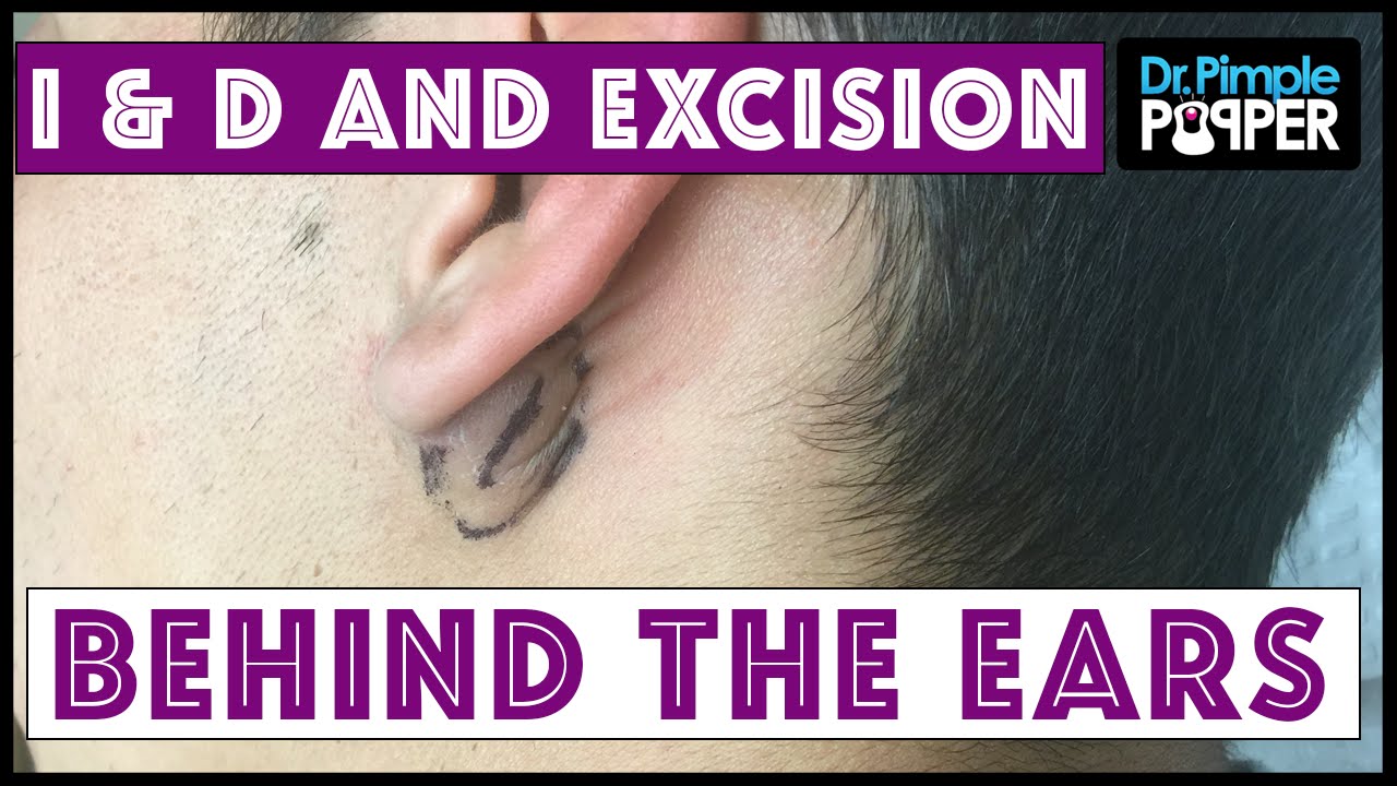 Cyst Behind Ear