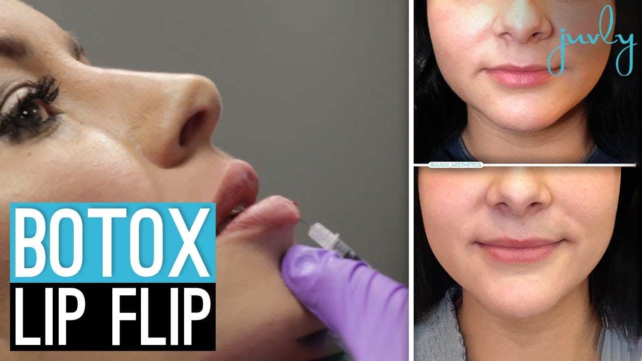 Lip Flip Botox Before And After Photos Infoupdate Org