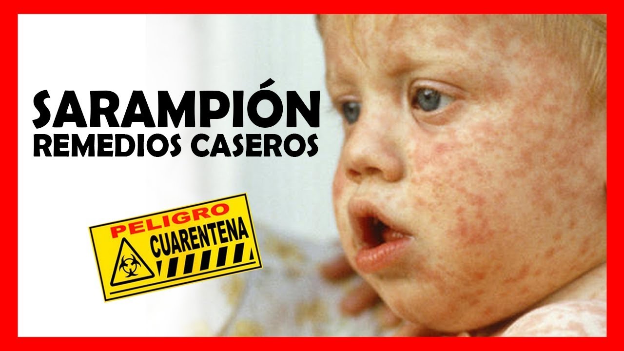 Sarampión En Bebes Remedios Caseros Vive Saludable Youtube
