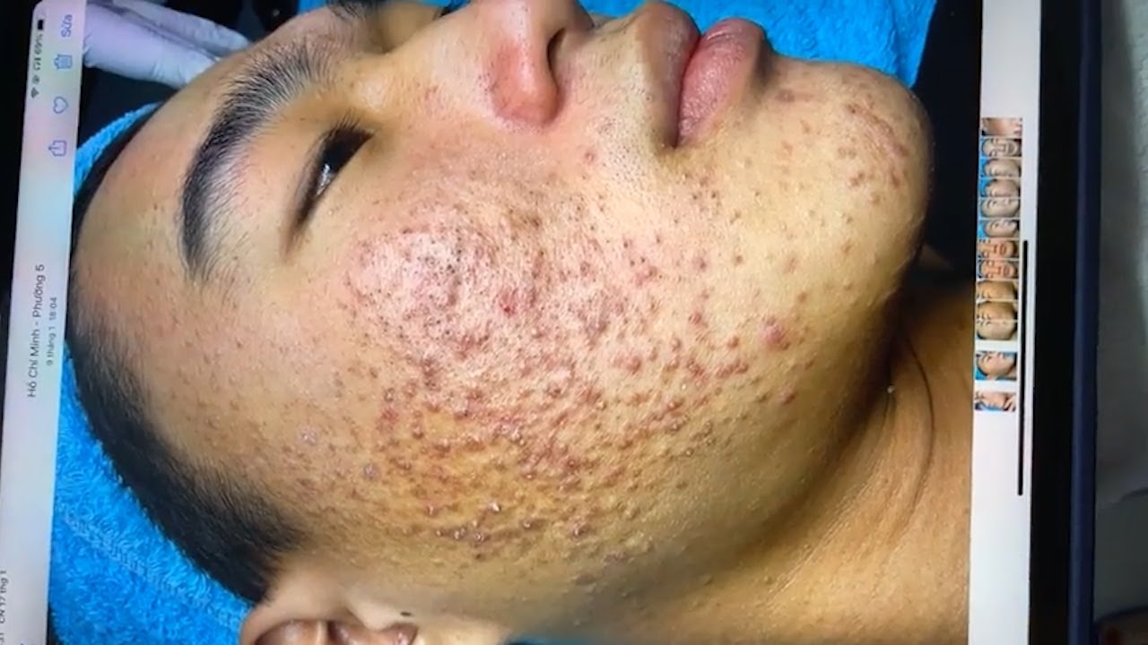 Relax With Massive Cystic Acne Popping Video